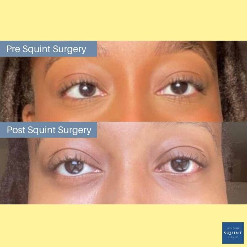 Squint Surgery | The London Squint Clinic
