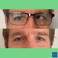 Squint Surgery | The London Squint Clinic
