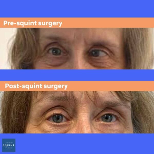 Squint Surgery | The London Squint Clinic