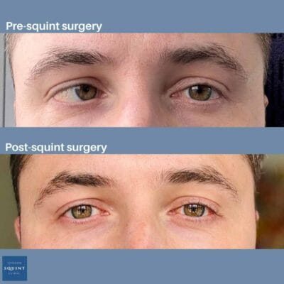 The London Squint Clinic | Squint, Treatment, Surgery, Squint Surgery