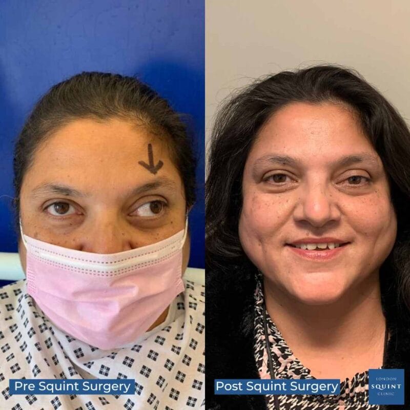 Squint Surgery | The London Squint Clinic