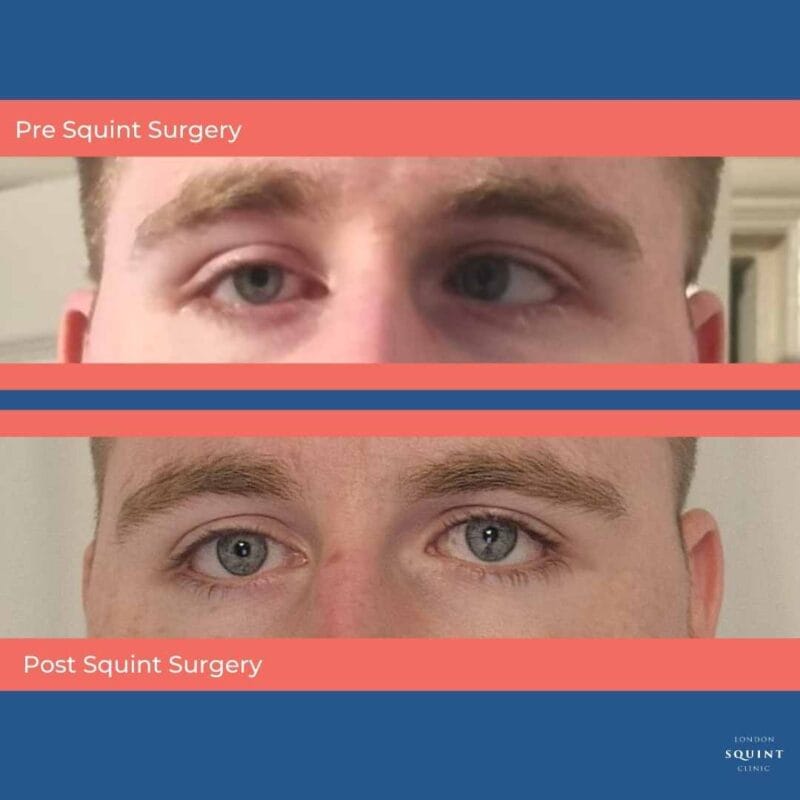 Squint Surgery | The London Squint Clinic