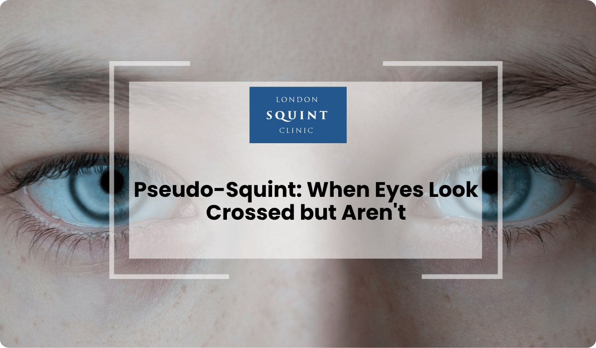 Pseudo-Squint: When Eyes Look Crossed but Aren't | The London Squint Clinic